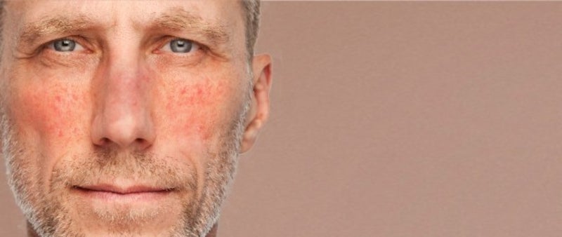 Better understand rosacea | Face up to Rosacea